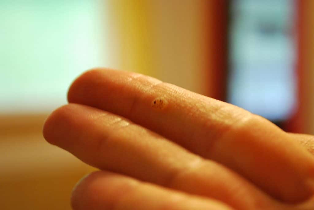 10 best essential oils for warts removal - Essential oils to ged rid of ...